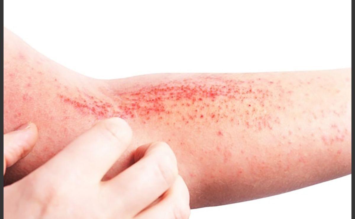 La dermatitis atópica es la enfermedad cutánea crónica más común y 170. ...